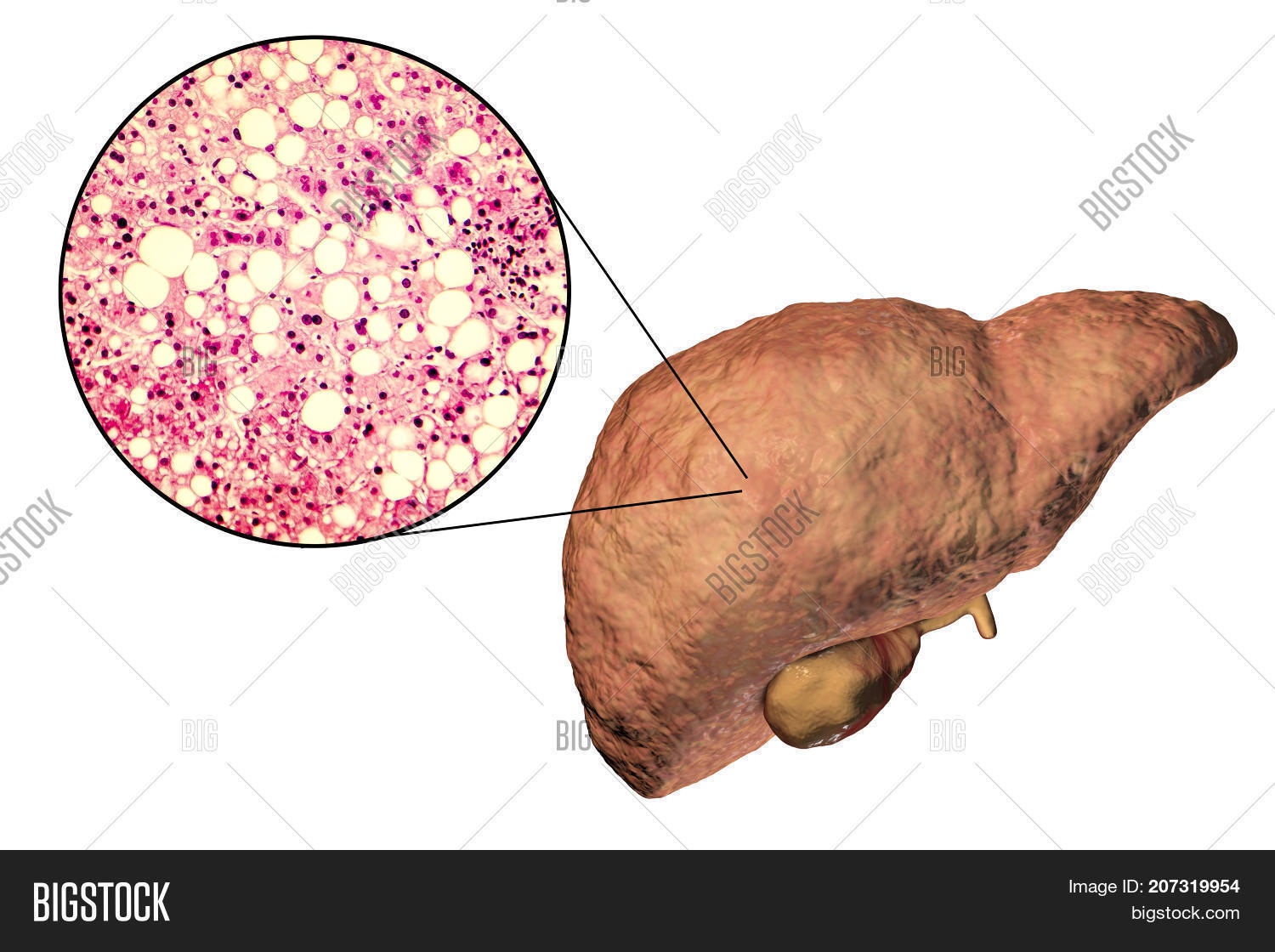 Fatty Liver, Liver Image & Photo (Free Trial) | Bigstock