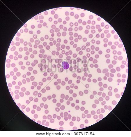 Atypical Lymphocyte On Image & Photo (Free Trial) | Bigstock