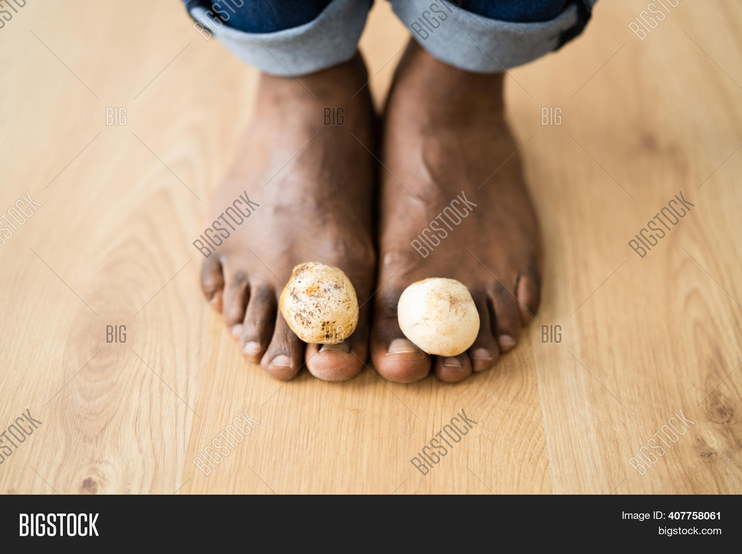 Feet Fungus Mushroom Image & Photo (Free Trial) | Bigstock