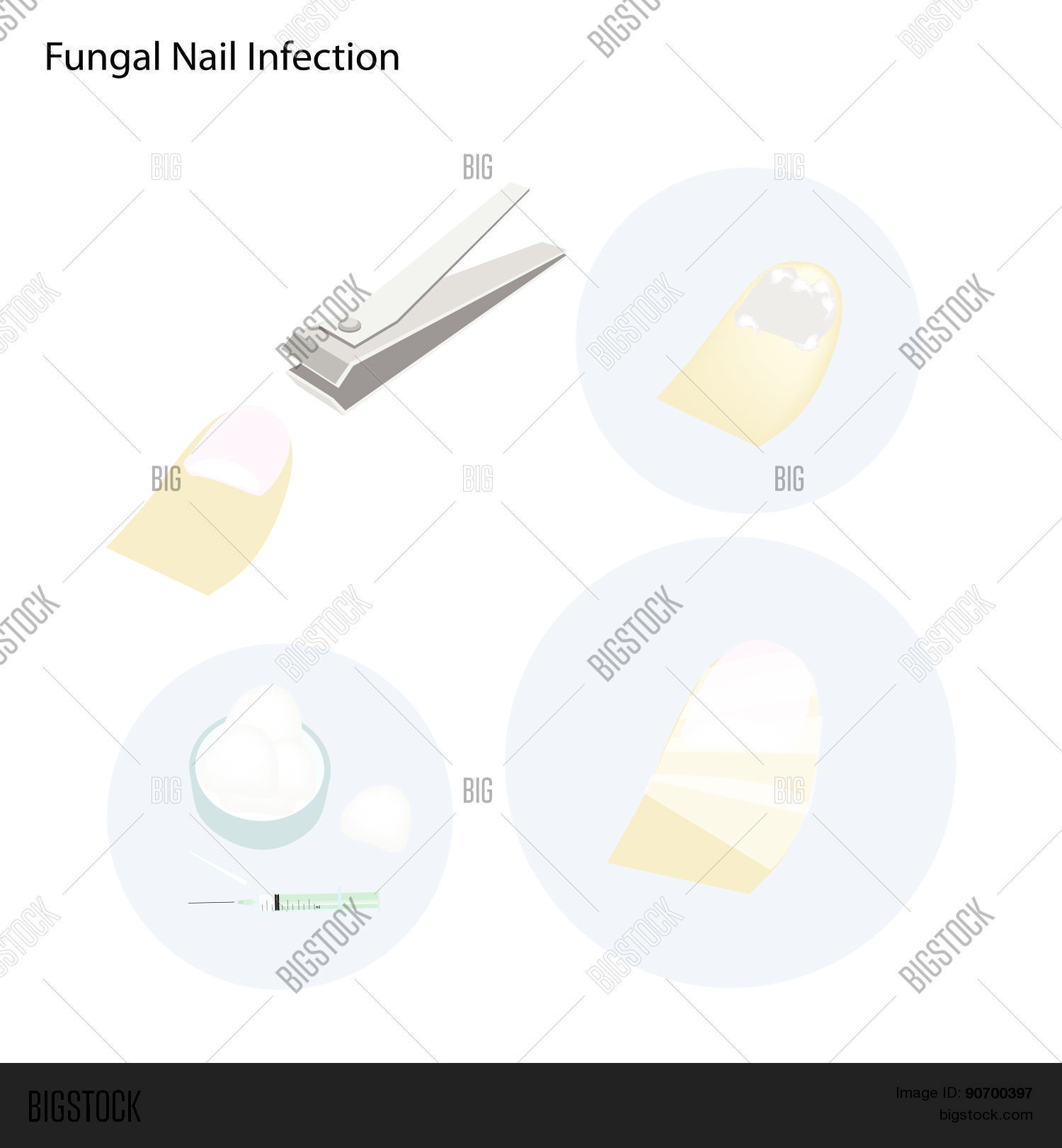 Fungal Nail Infection Vector & Photo (Free Trial) | Bigstock