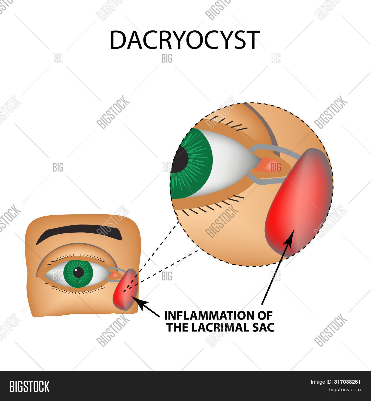 Dacryocyst. Image & Photo (Free Trial) | Bigstock
