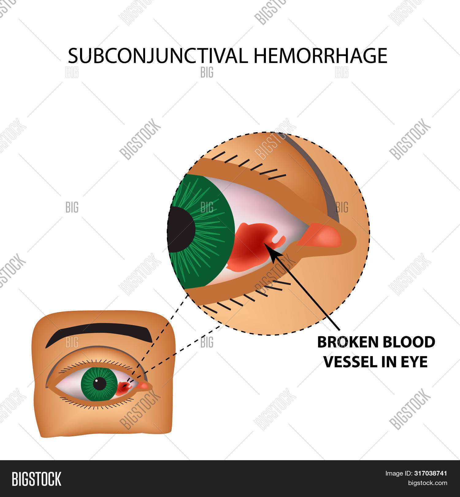Vessel Eye Burst. Image & Photo (Free Trial) | Bigstock