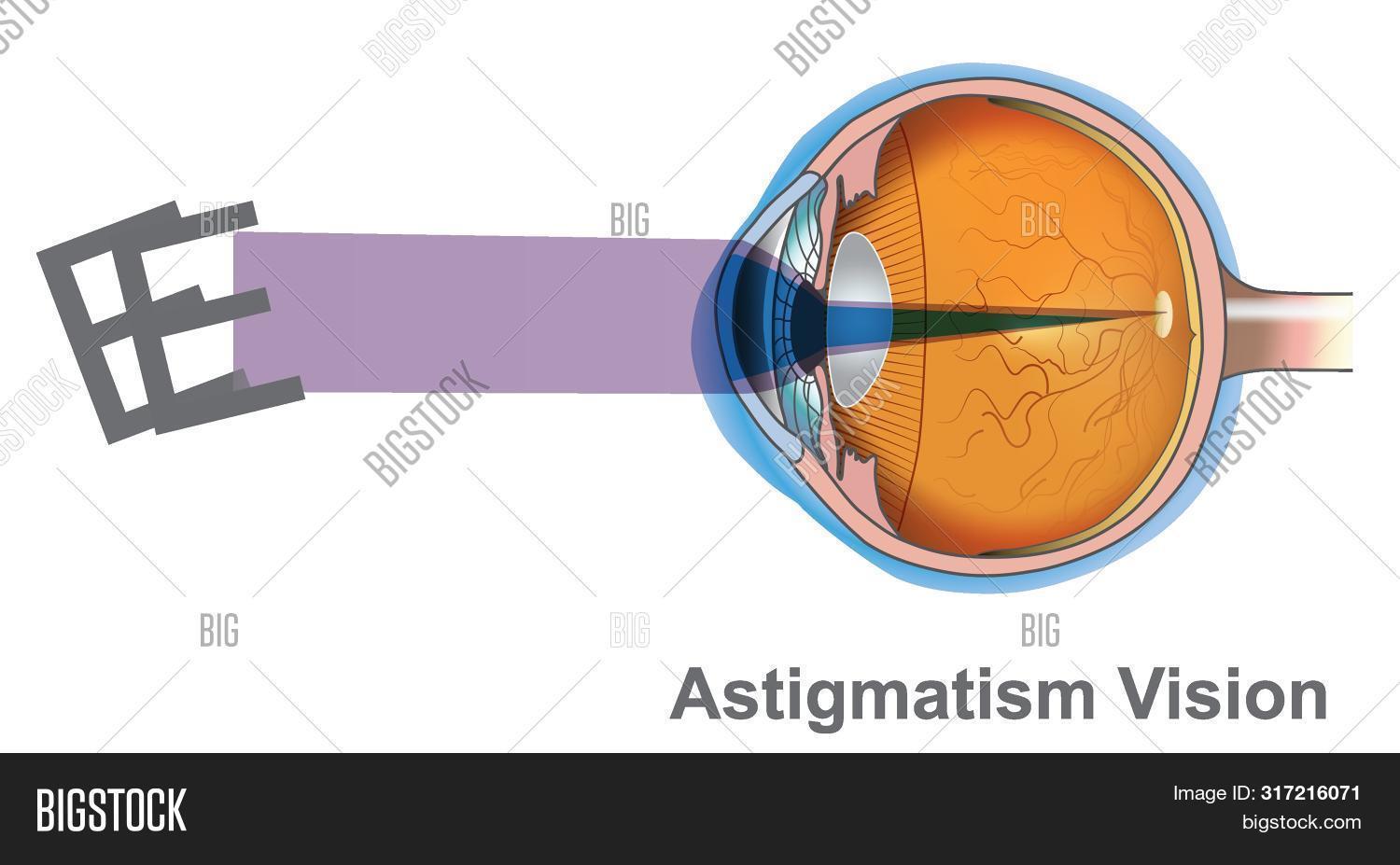 Astigmatism Vision. 3d Image & Photo (Free Trial) | Bigstock