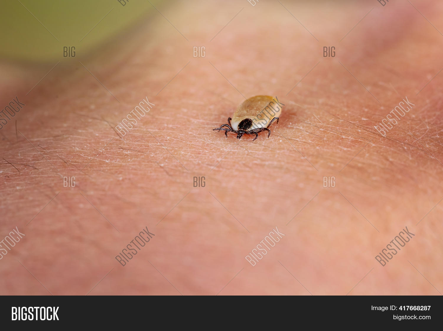 Engorged Tick On Human Image & Photo (Free Trial) | Bigstock