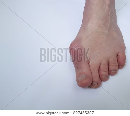 Valgus Female Leg On Image & Photo (Free Trial) | Bigstock