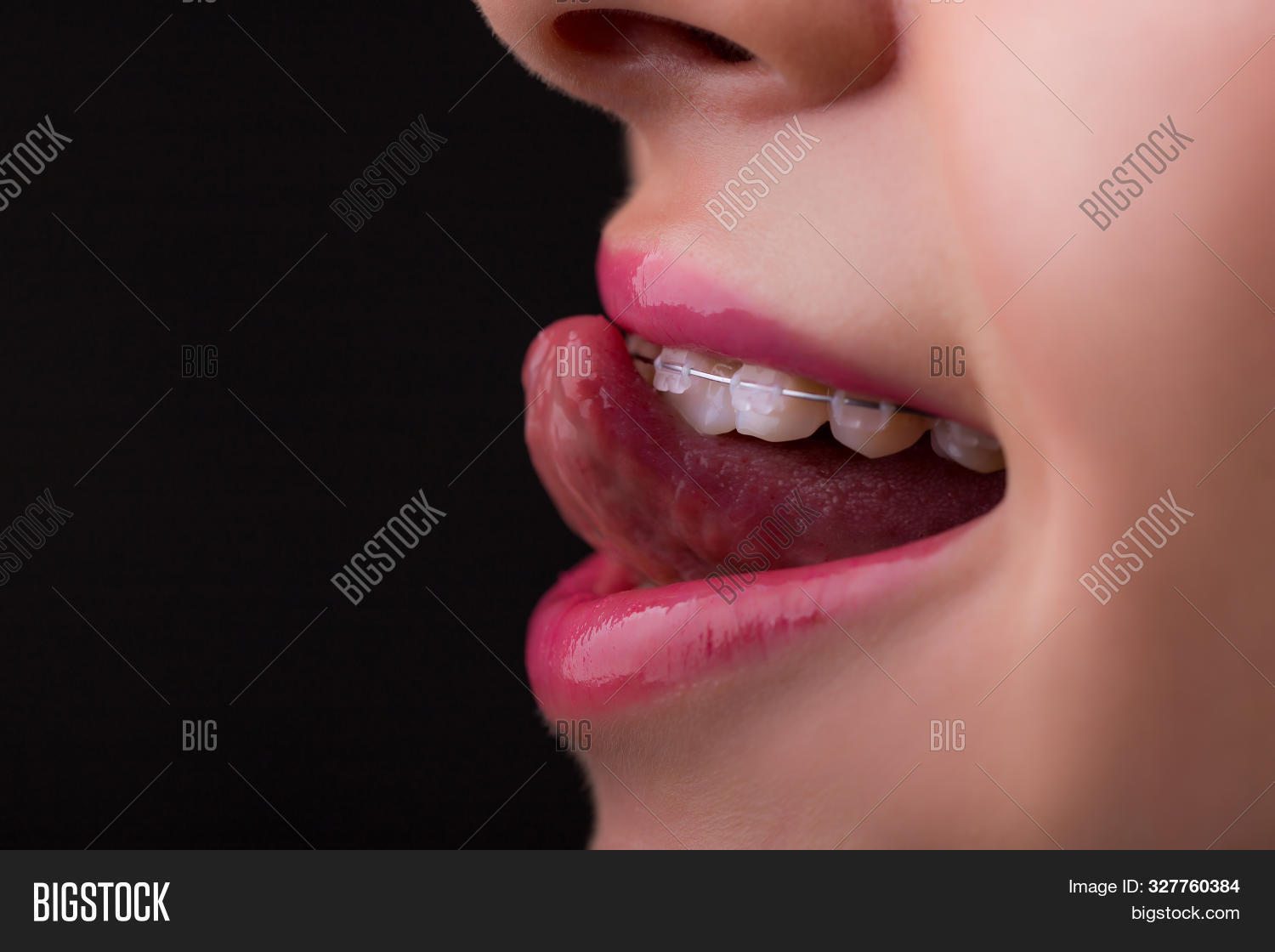 Braces. Beautiful Image & Photo (Free Trial) | Bigstock