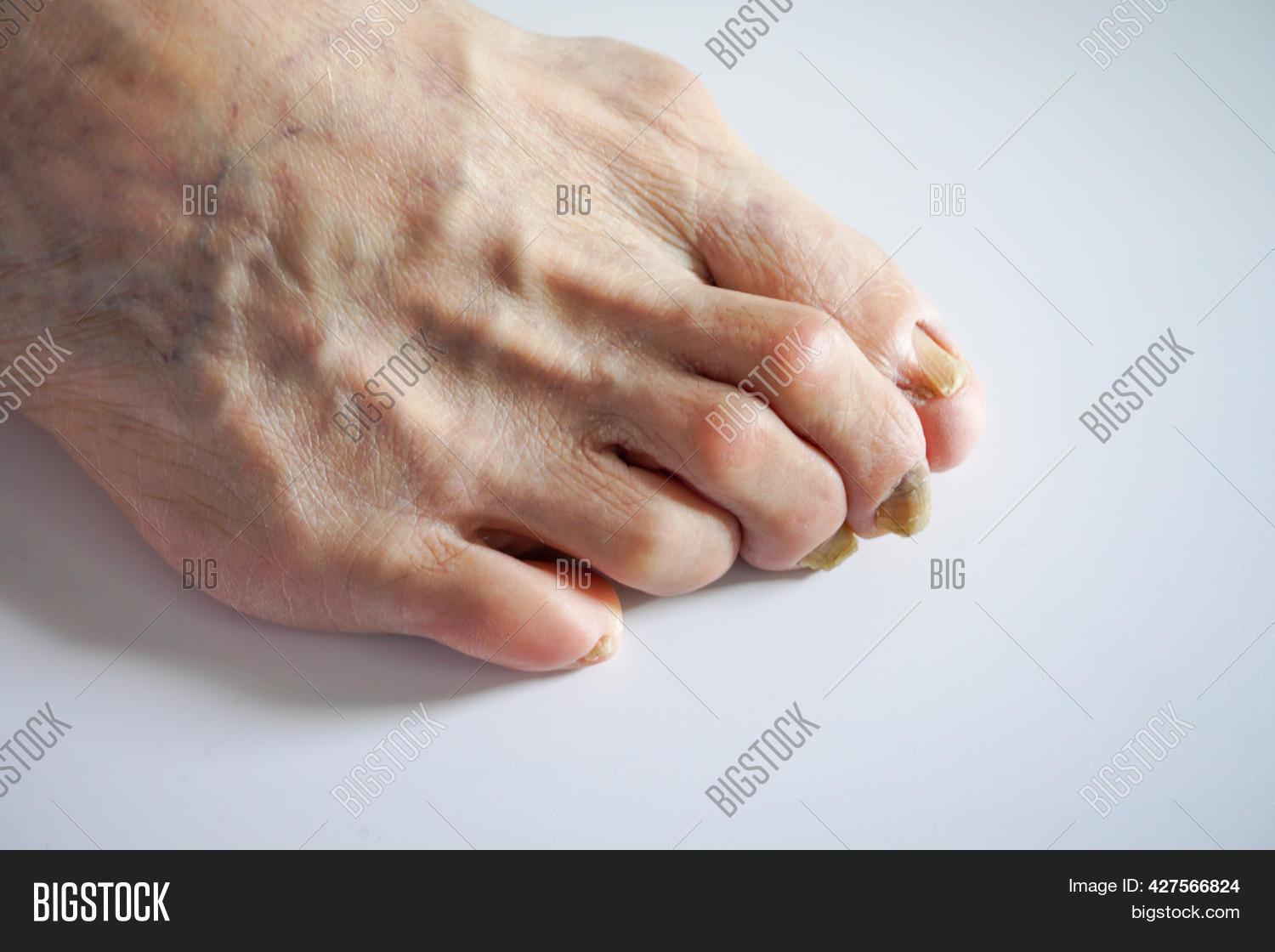 Old Mans Foot Deformed Image & Photo (Free Trial) | Bigstock
