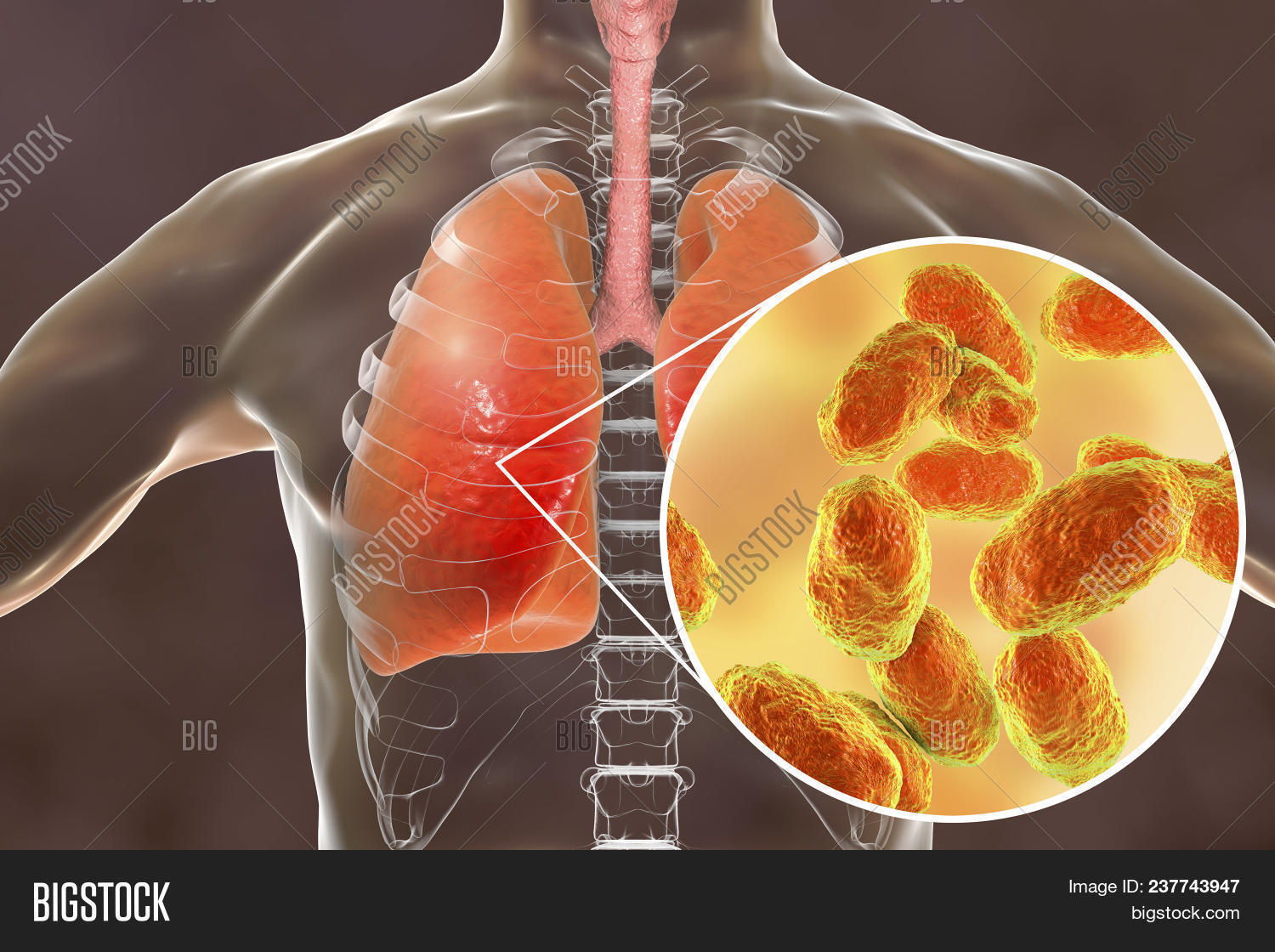 Pneumonia Caused By Image & Photo (Free Trial) | Bigstock