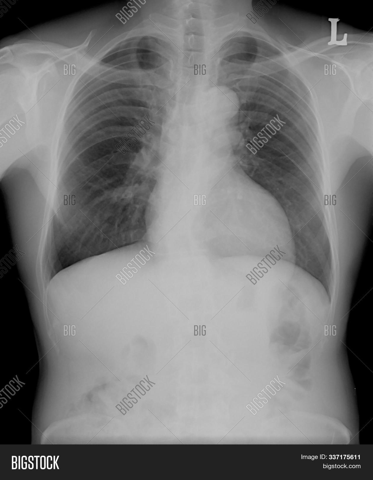 Chest Tomography,x-ray Image & Photo (Free Trial) | Bigstock