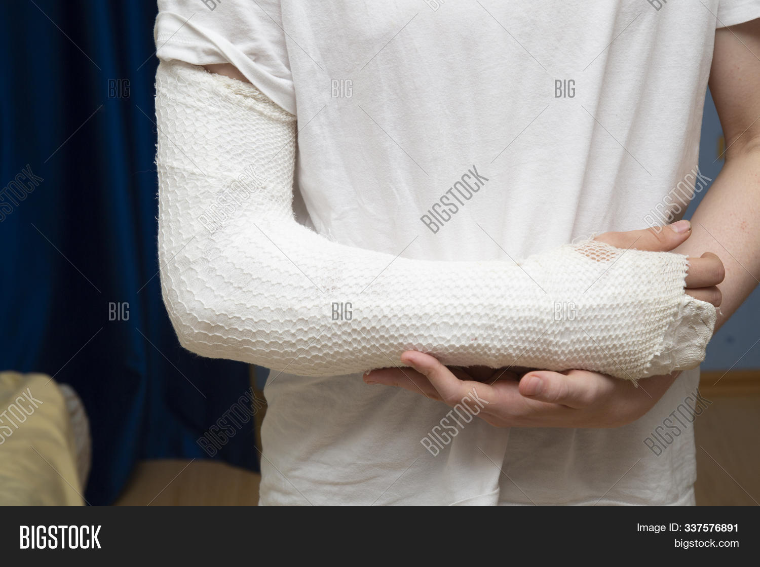 Broken Arm. Fracture Image & Photo (Free Trial) | Bigstock