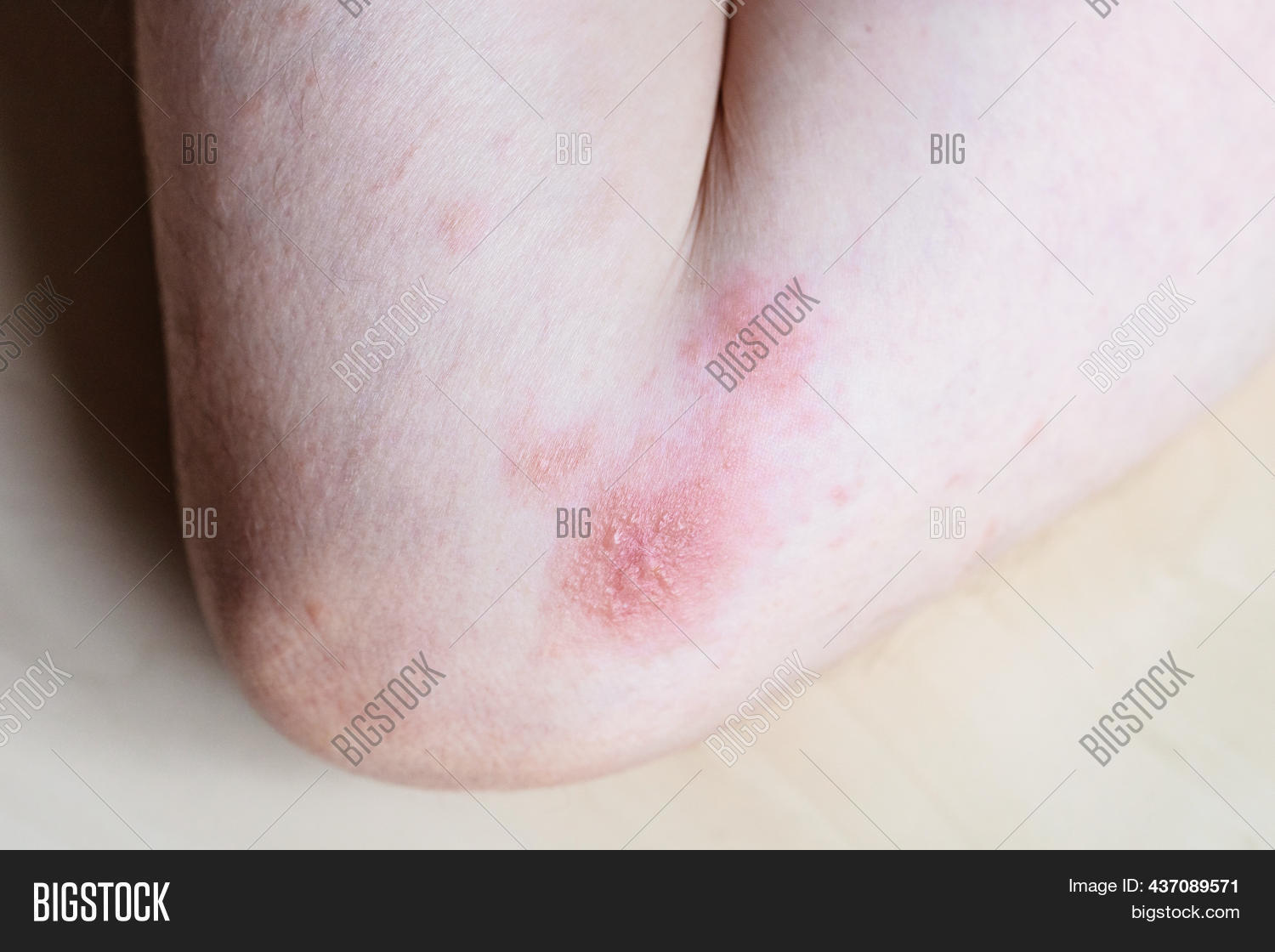 Sample Allergic Image & Photo (Free Trial) | Bigstock