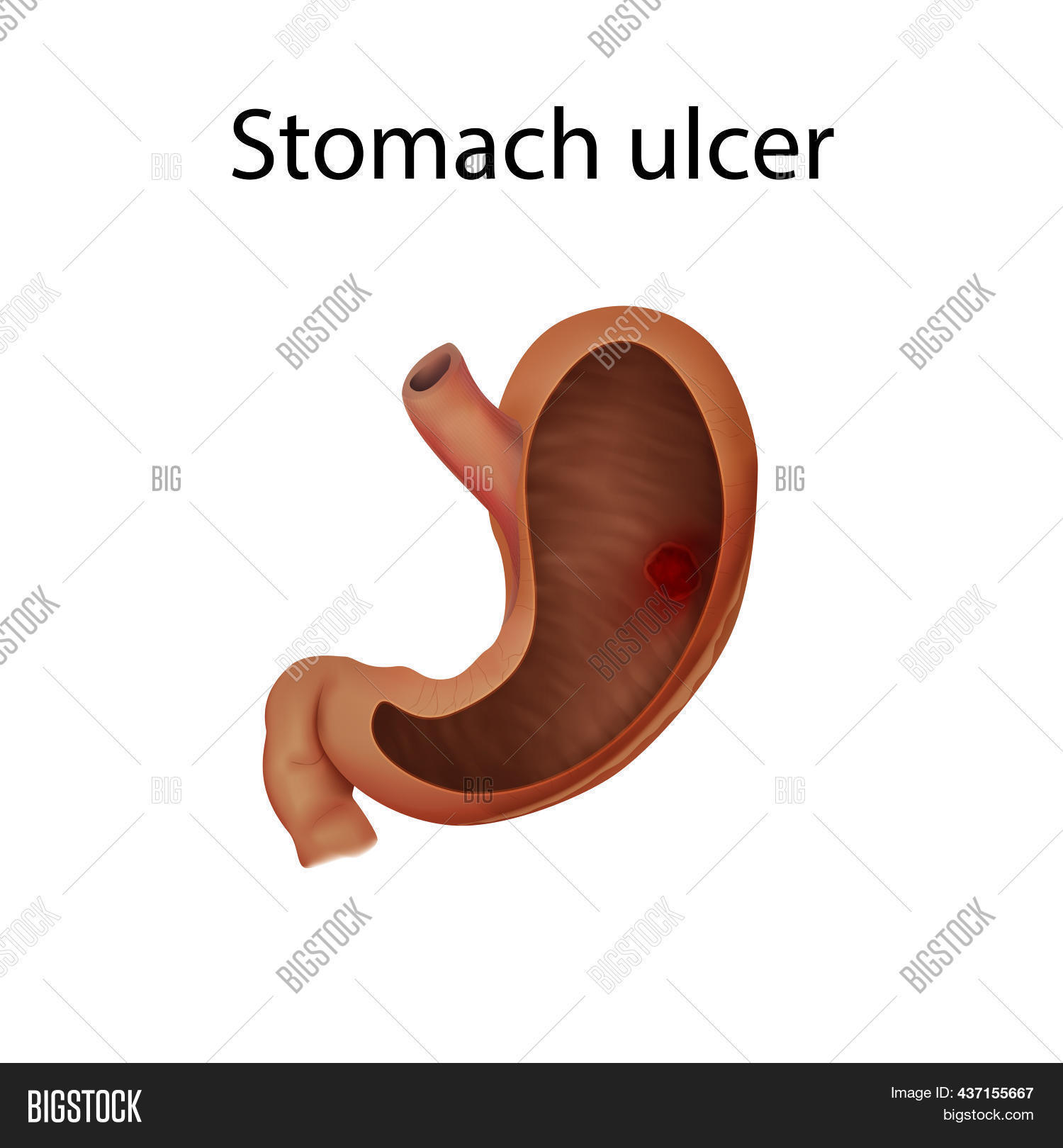 Stomach Ulcer. Image & Photo (Free Trial) | Bigstock