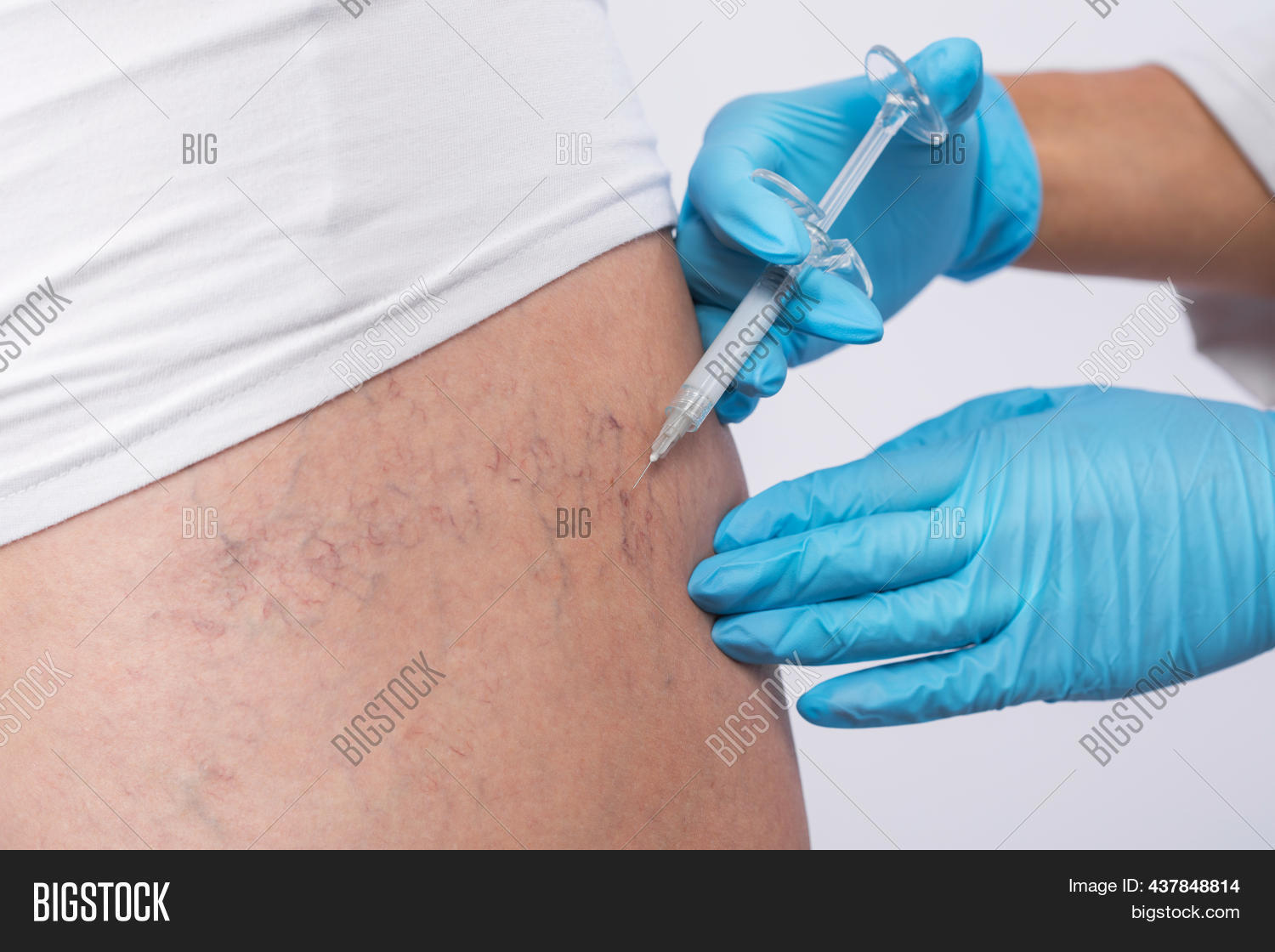 Removal Varicose Veins Image & Photo (Free Trial) | Bigstock