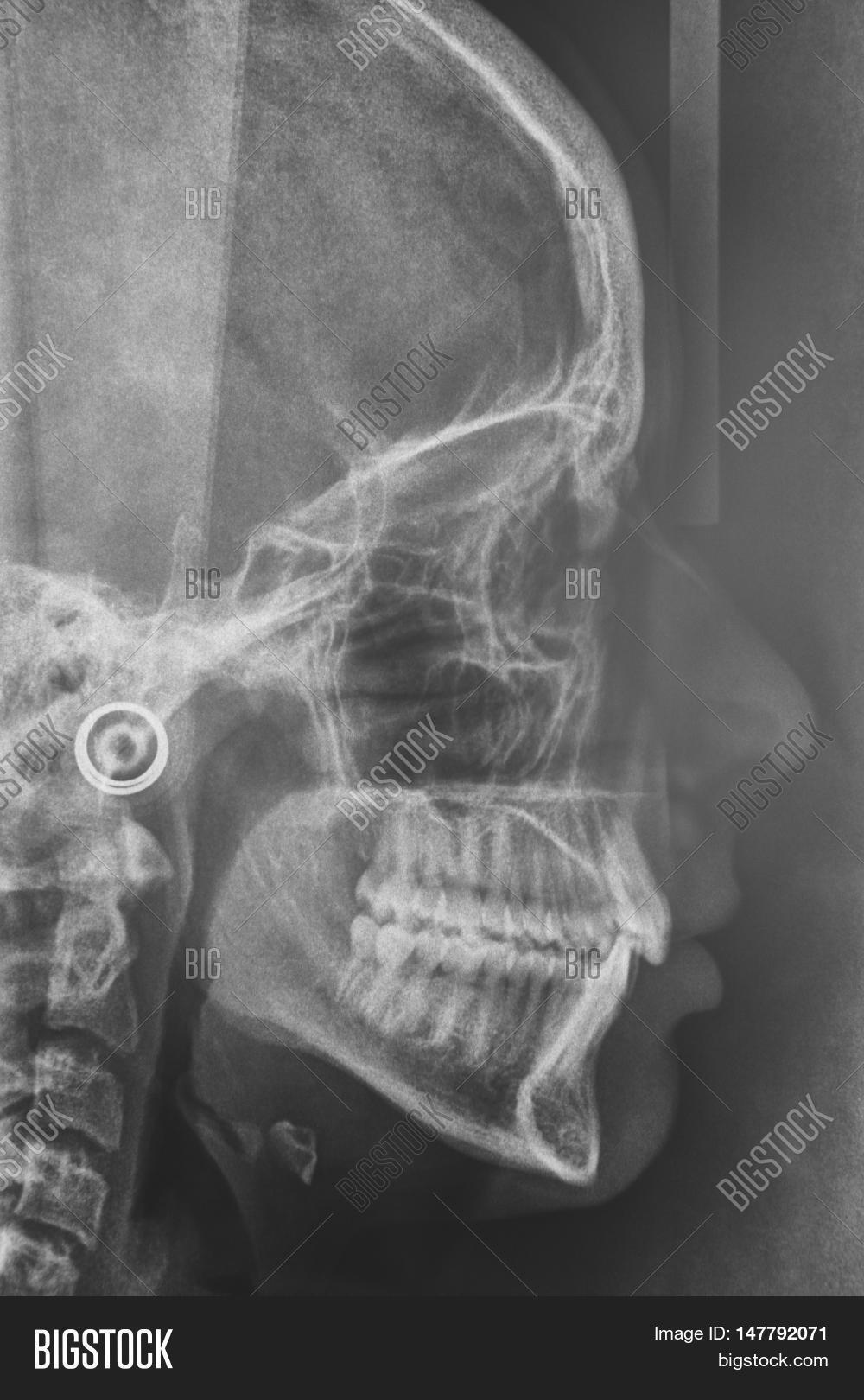 Maxilofacial X-Ray Image & Photo (Free Trial) | Bigstock