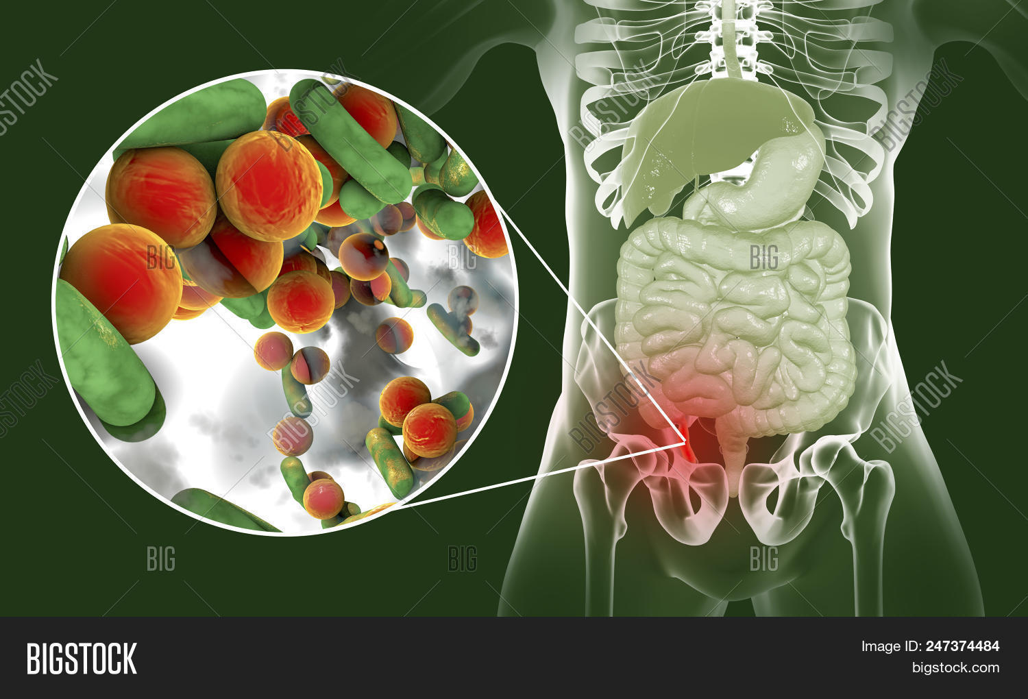 Acute Appendicitis Image & Photo (Free Trial) | Bigstock