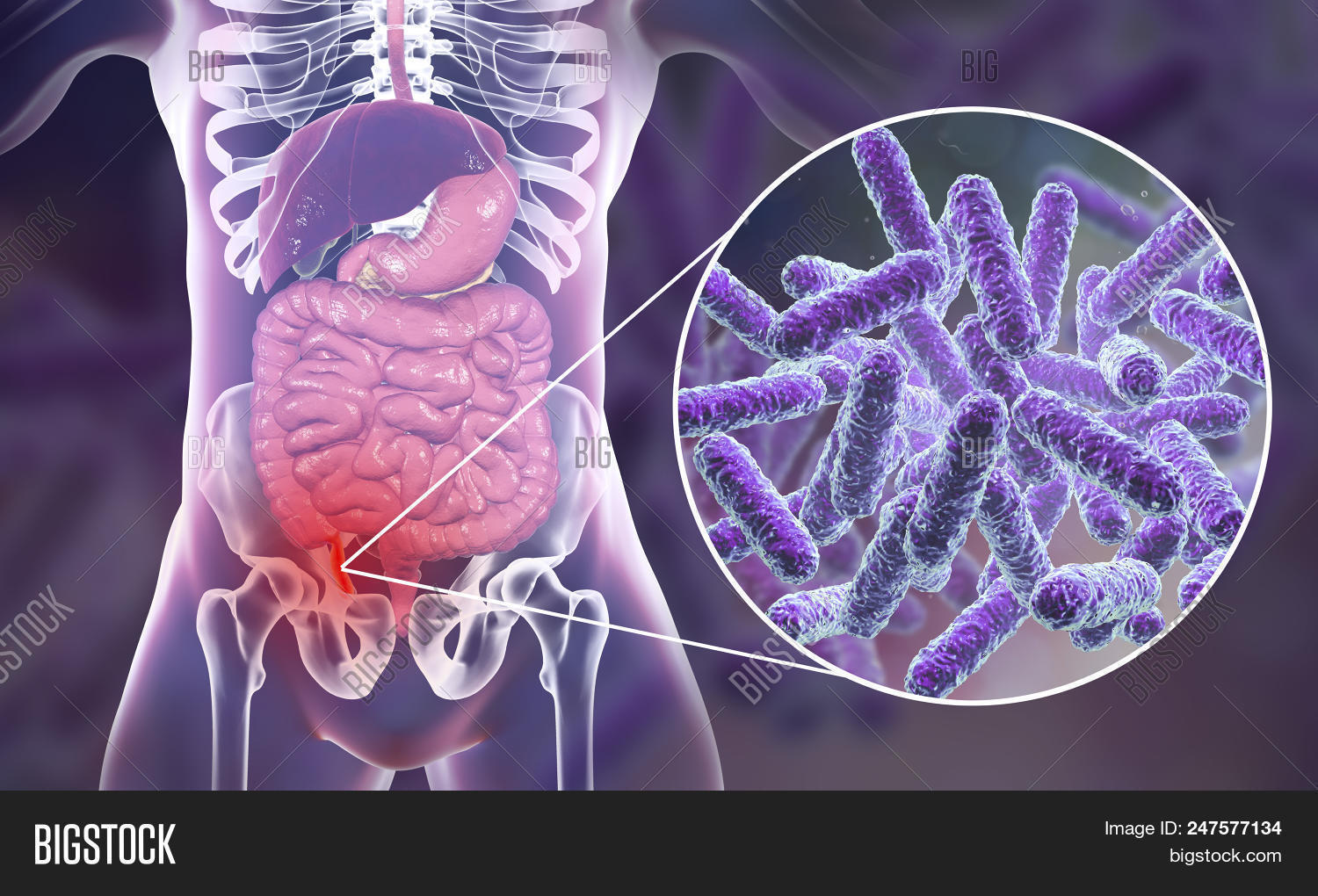 Acute Appendicitis Image & Photo (Free Trial) | Bigstock