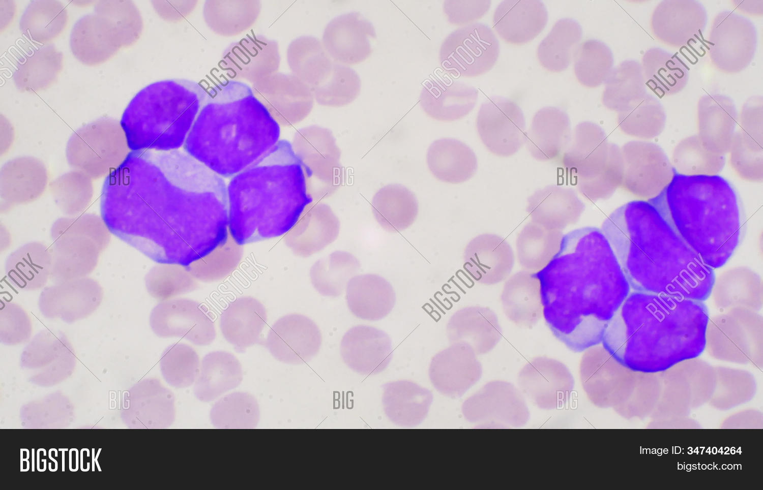 Blast Cell Leukemia Image & Photo (Free Trial) | Bigstock