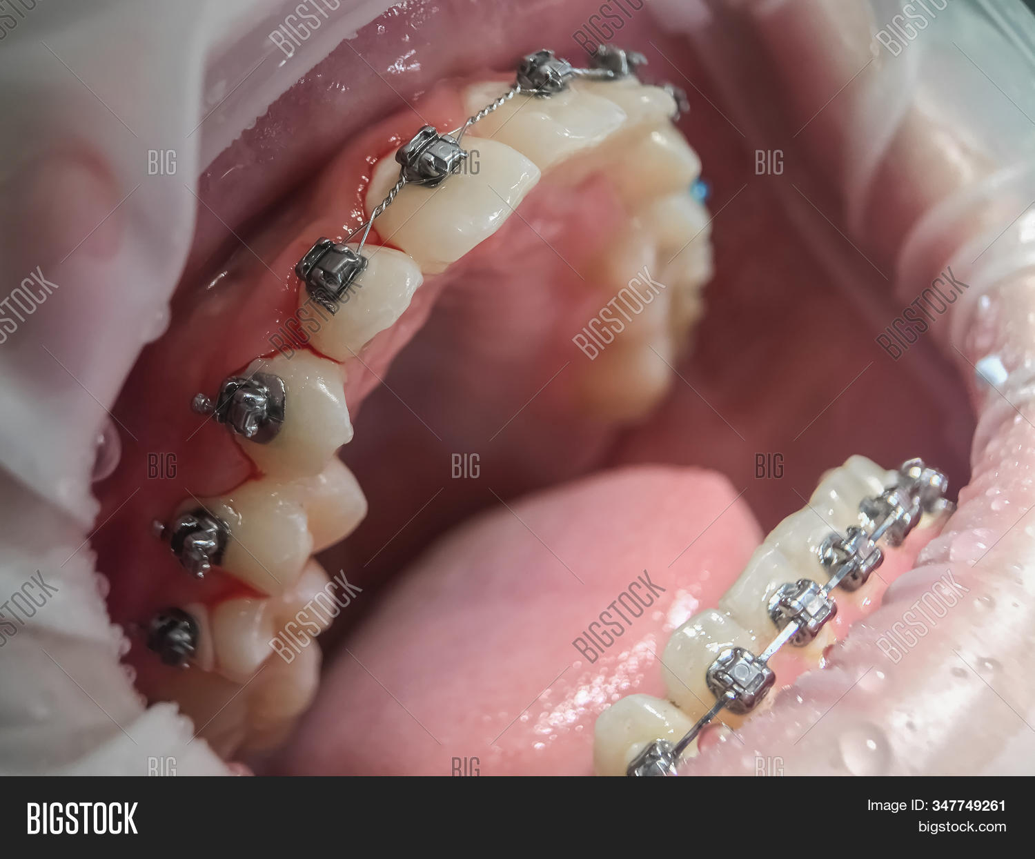 Model Human Jaw Wire Image & Photo (Free Trial) | Bigstock