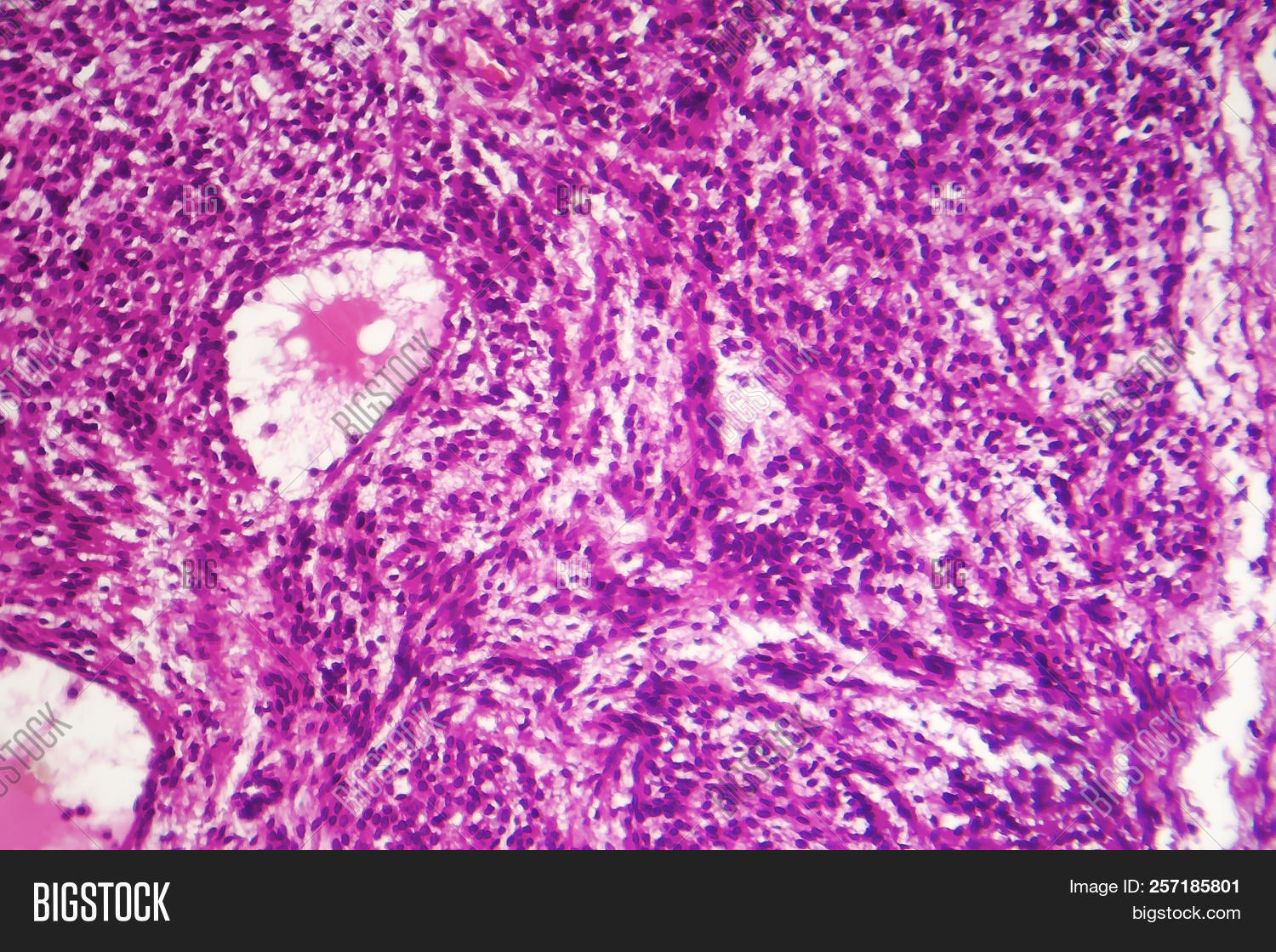 Fibrosarcoma, Image & Photo (Free Trial) | Bigstock