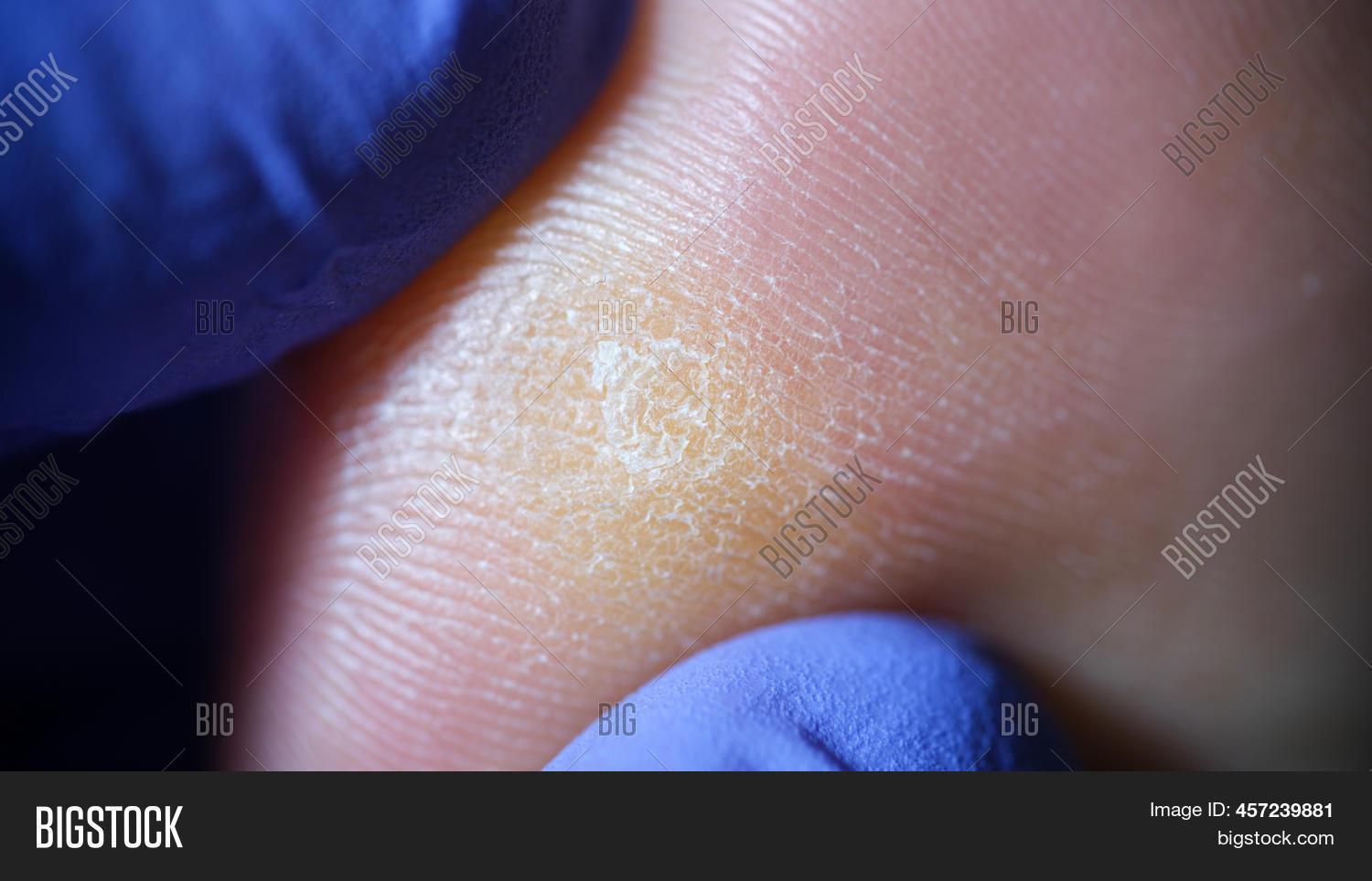 Inflamed Dry Callus Image & Photo (Free Trial) | Bigstock