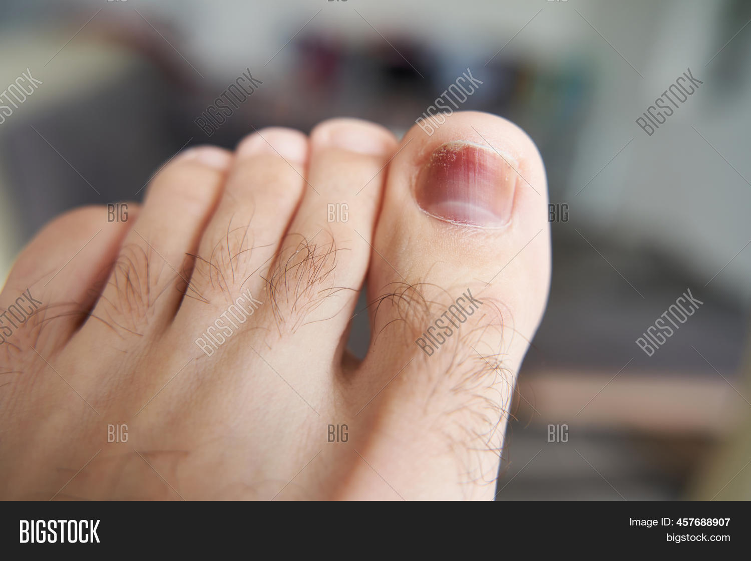 Toe Injured, Heavy Image & Photo (Free Trial) | Bigstock