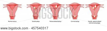 Set Polyps Uterus Vector & Photo (Free Trial) | Bigstock