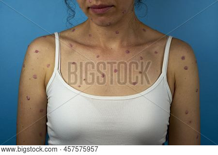 Itchy Rash On 图片和照片（免费试用） | Bigstock