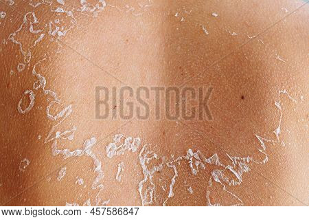 Shedding Skin After Image & Photo (Free Trial) | Bigstock