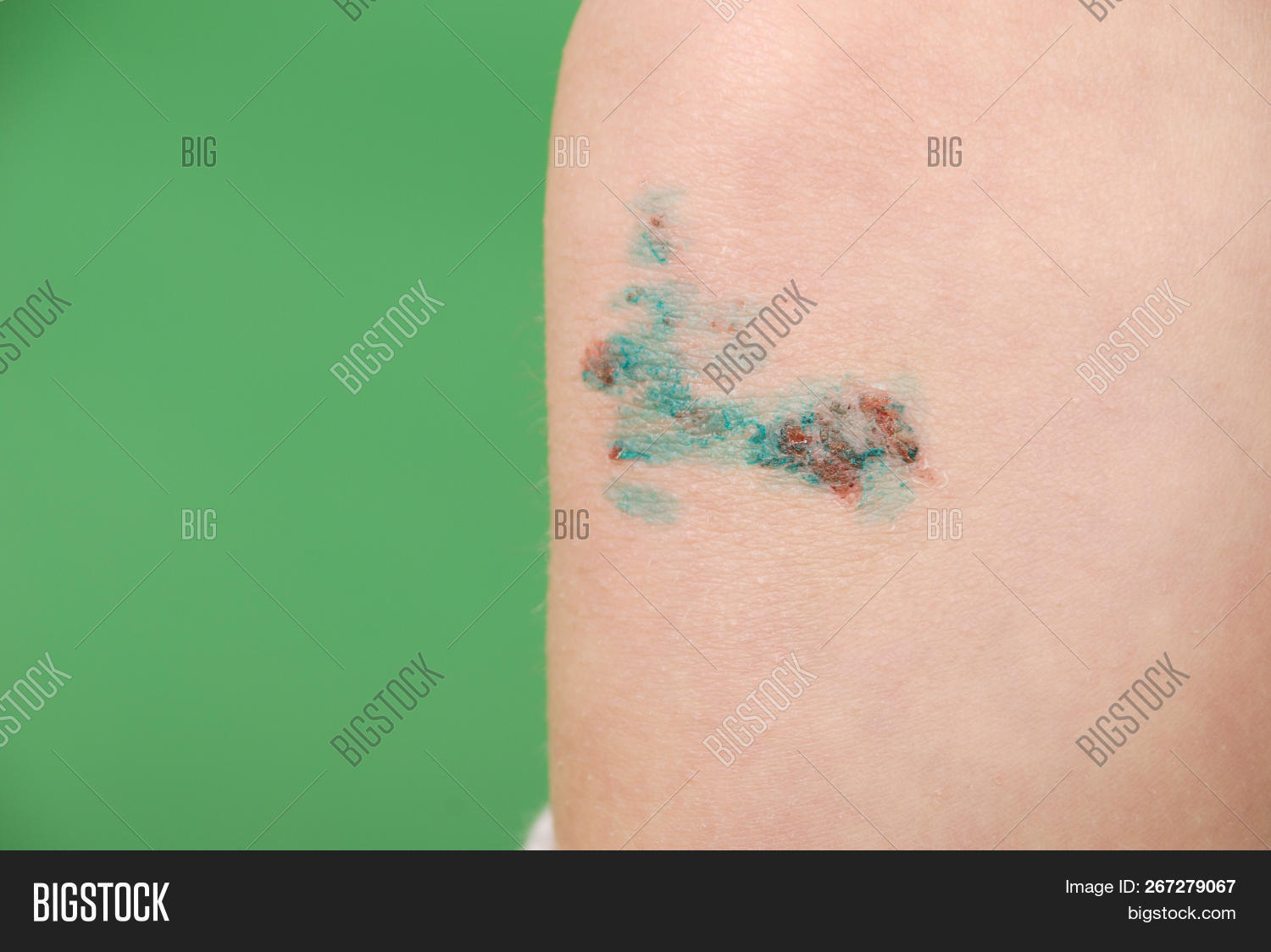Scraped Knee Little Image & Photo (Free Trial) | Bigstock