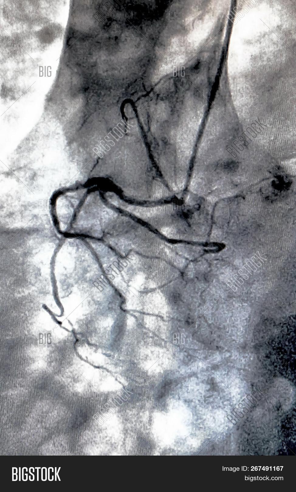 Catheterization. Image & Photo (Free Trial) | Bigstock