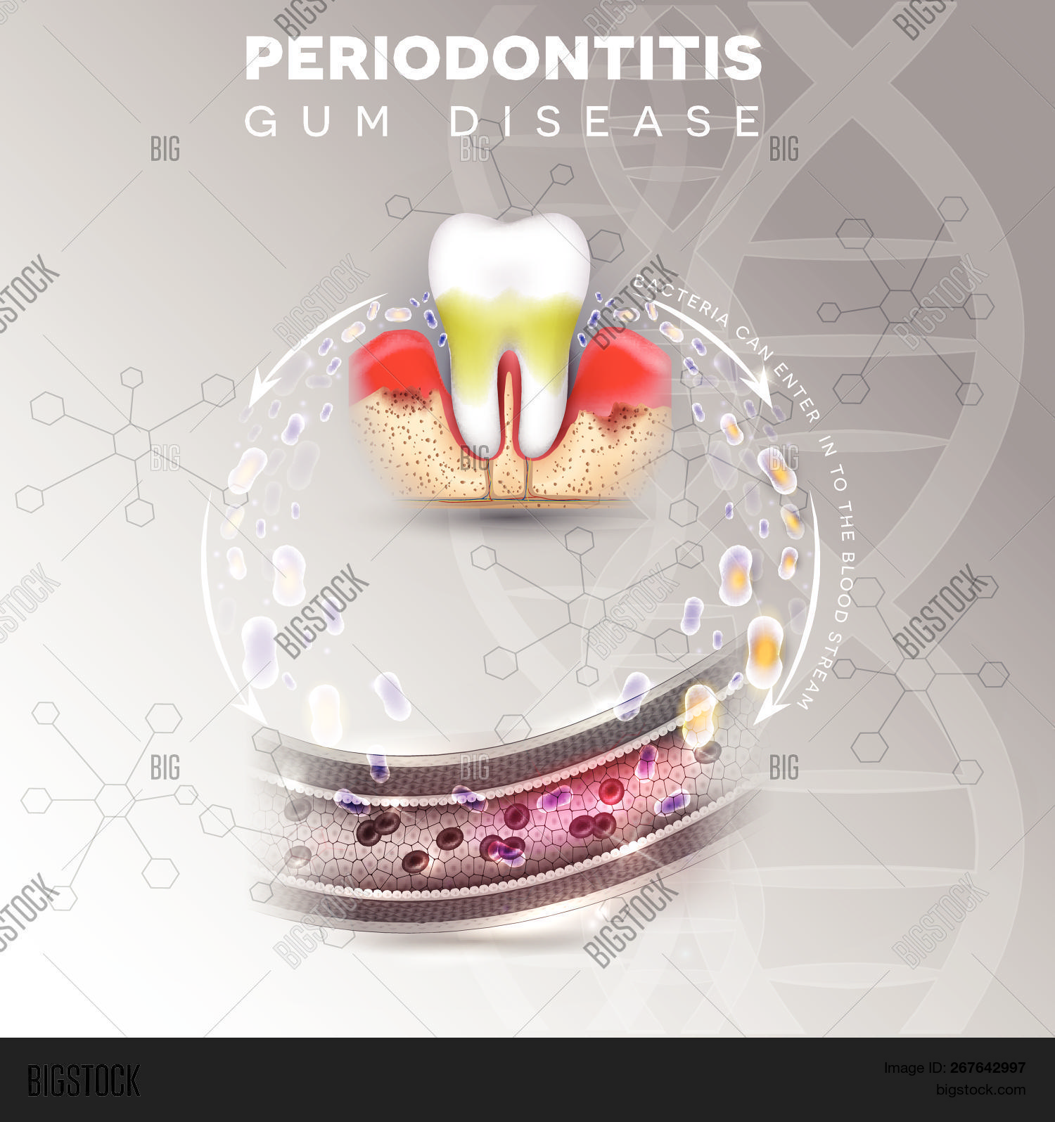 Periodontitis, Vector & Photo (Free Trial) | Bigstock