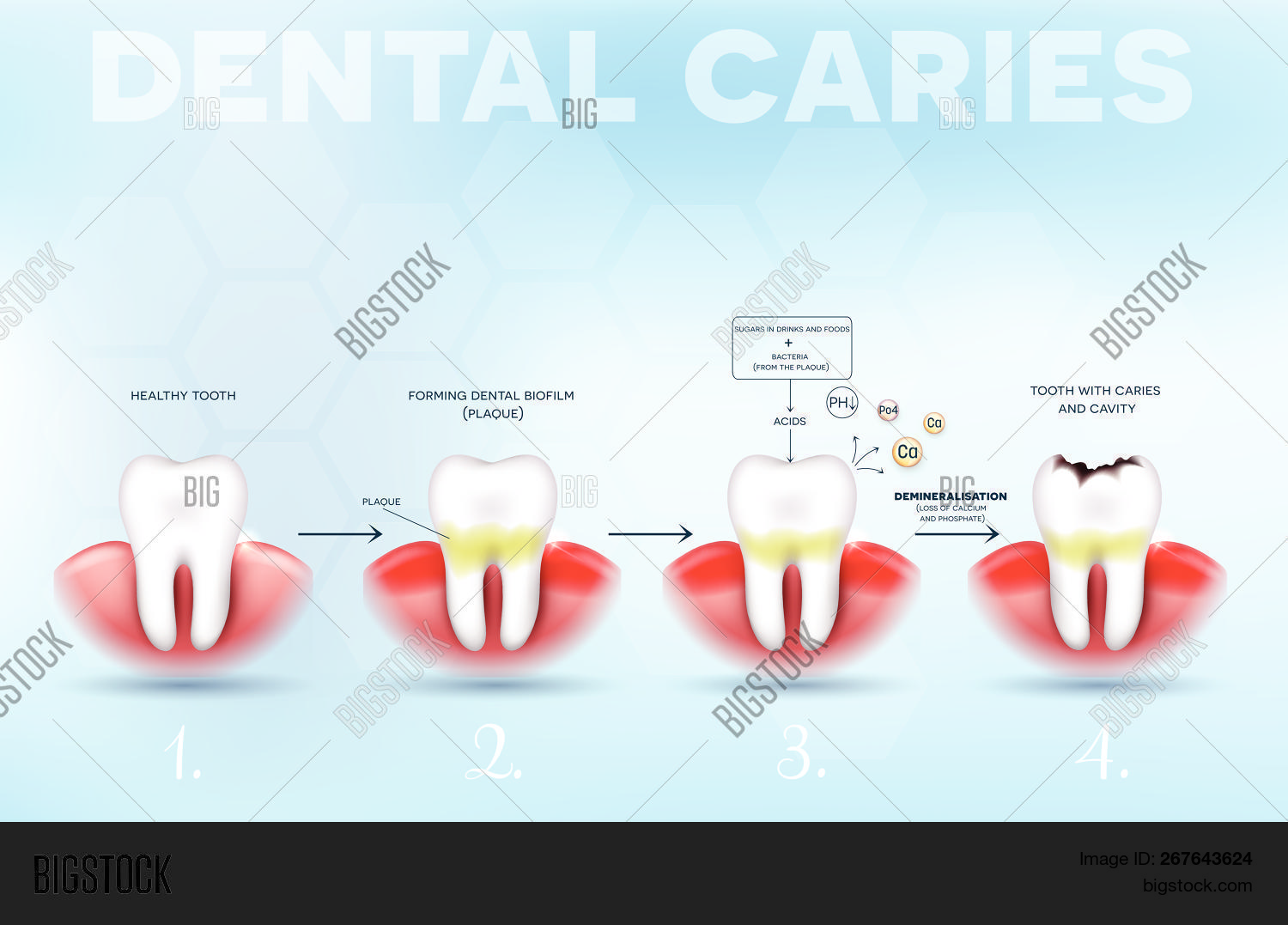 Tooth Decay, Dental Vector & Photo (Free Trial) | Bigstock