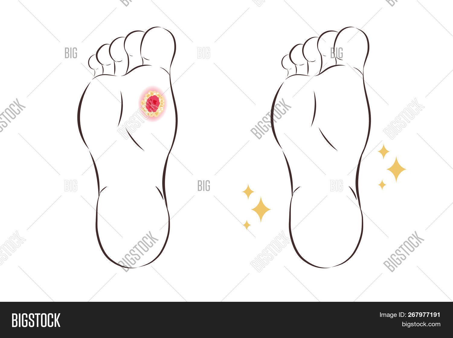 Ulcers On Inside Vector & Photo (Free Trial) | Bigstock