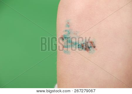 Scraped Knee Little Image & Photo (Free Trial) | Bigstock