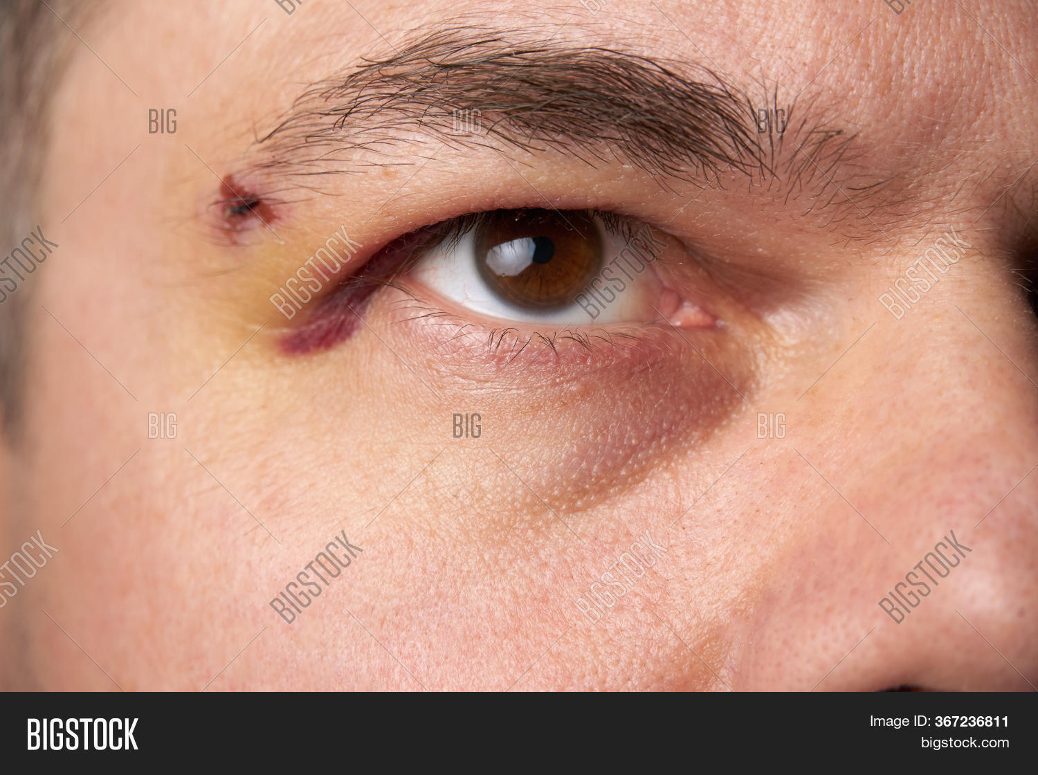 Close View Bruise Near Image & Photo (Free Trial) | Bigstock