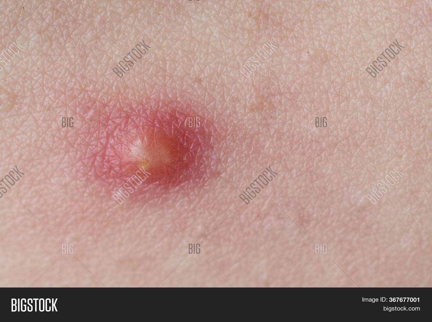 Pimple On Skin Image & Photo (Free Trial) | Bigstock