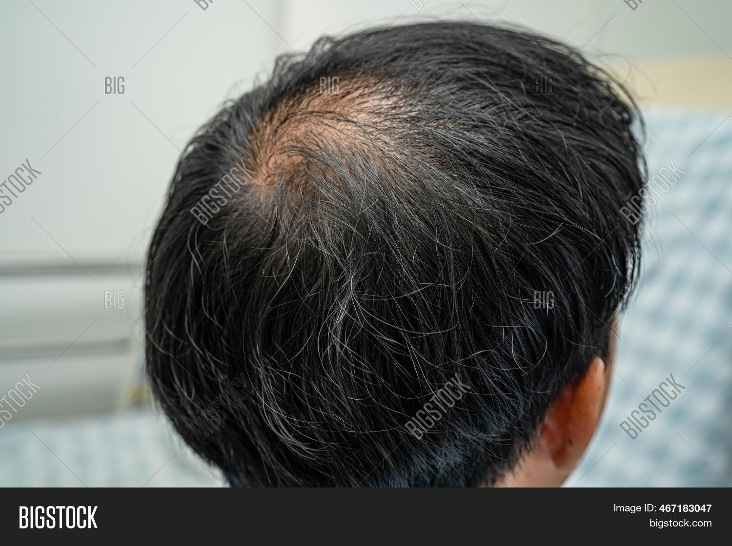 Bald Middle Head Begin Image & Photo (Free Trial) | Bigstock