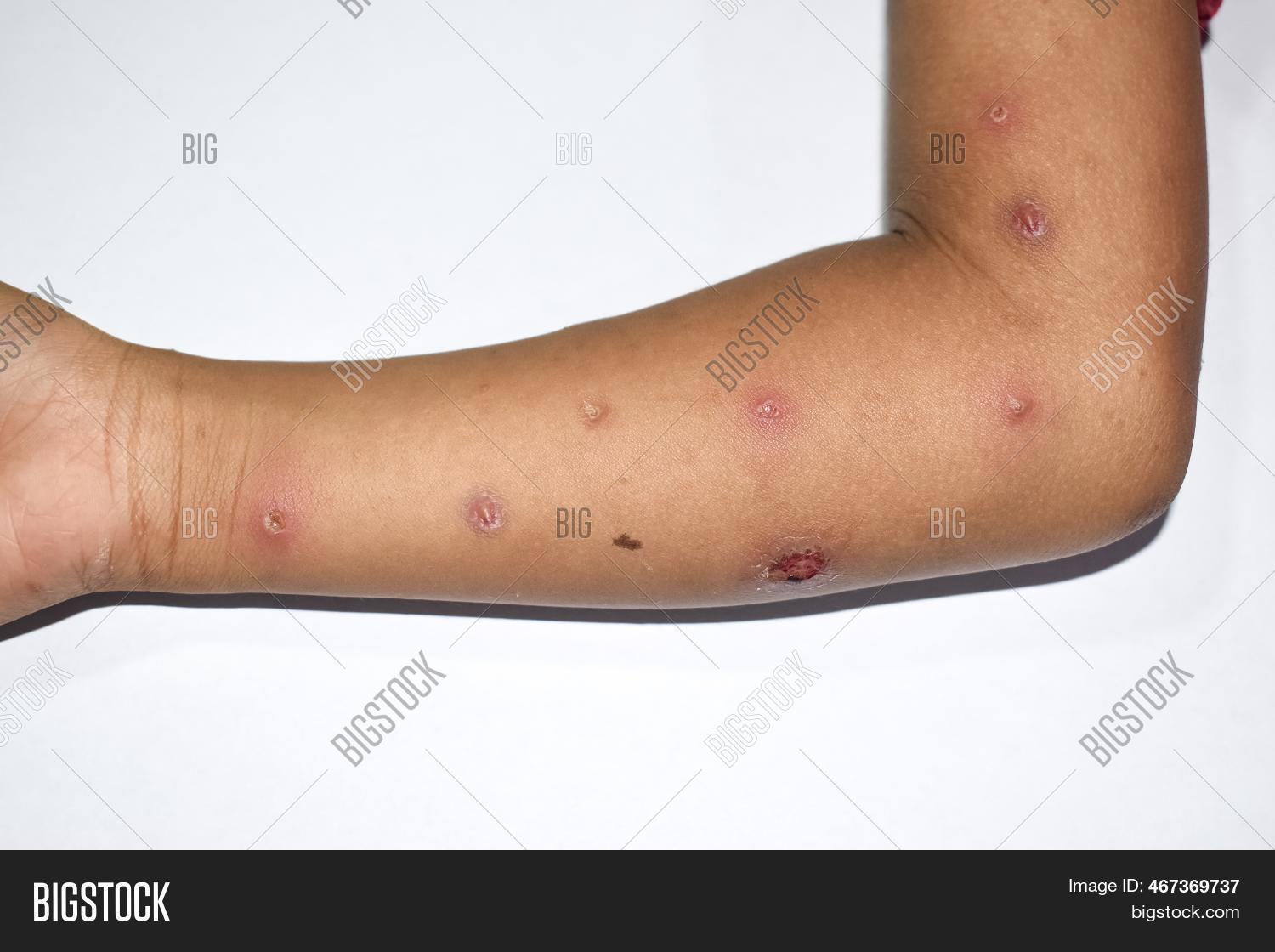 Monkeypox Skin Lesions Image & Photo (Free Trial) | Bigstock