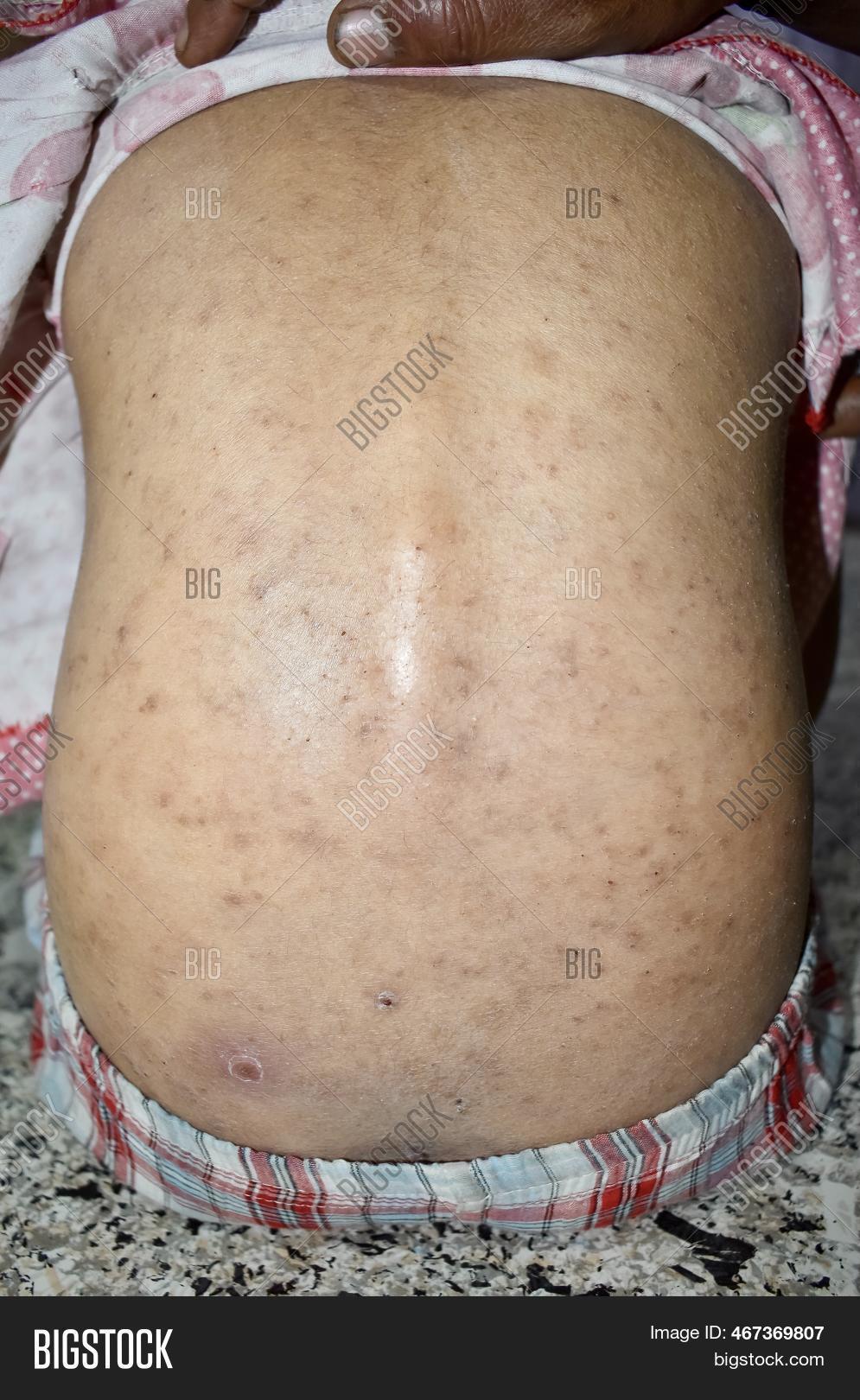 Scabies Infestation Image & Photo (Free Trial) | Bigstock
