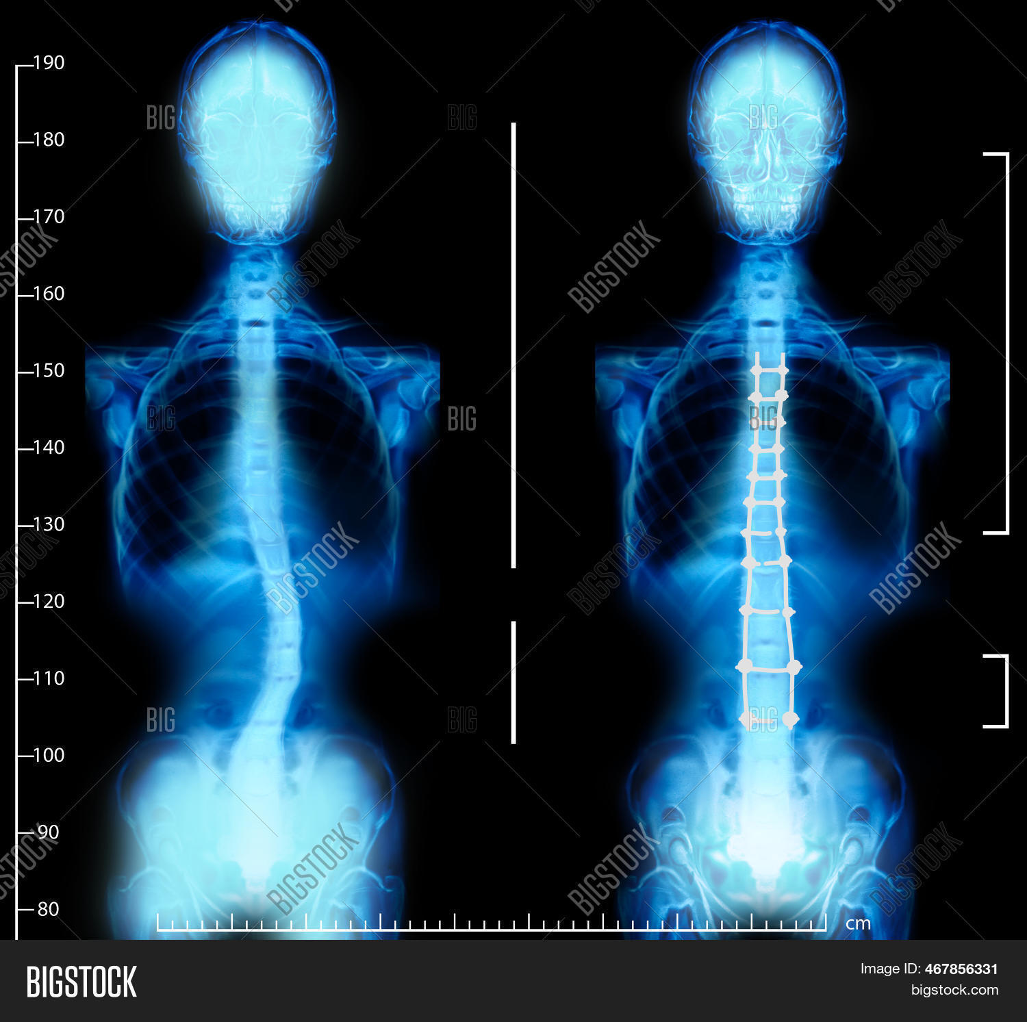 X-rays Human Normal Image & Photo (Free Trial) | Bigstock