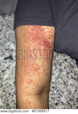 Chikungunya Rash On Image & Photo (Free Trial) | Bigstock