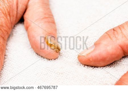 Nail Fungus Infection Image & Photo (Free Trial) | Bigstock