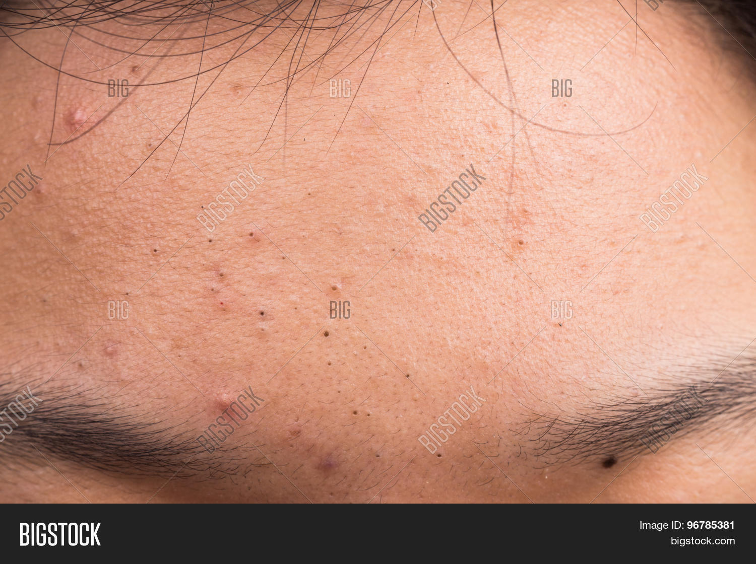 Closed- On Pimple Image & Photo (Free Trial) | Bigstock