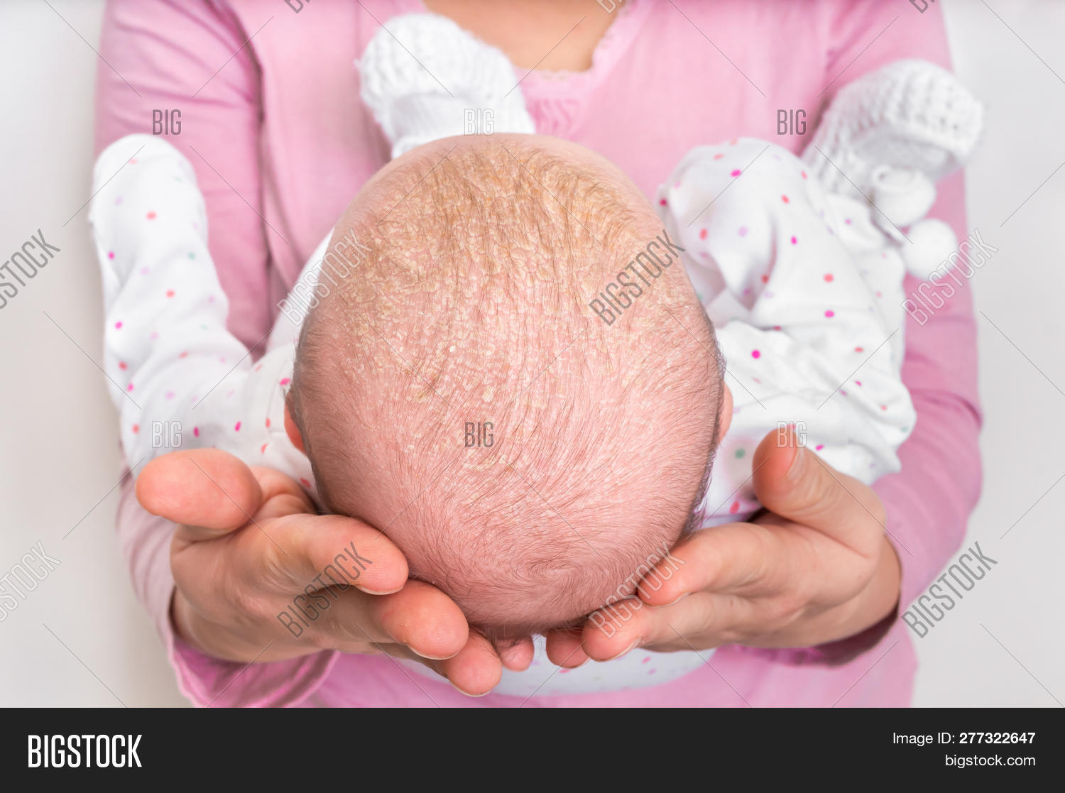 Newborn Baby Psoriasis Image & Photo (Free Trial) | Bigstock