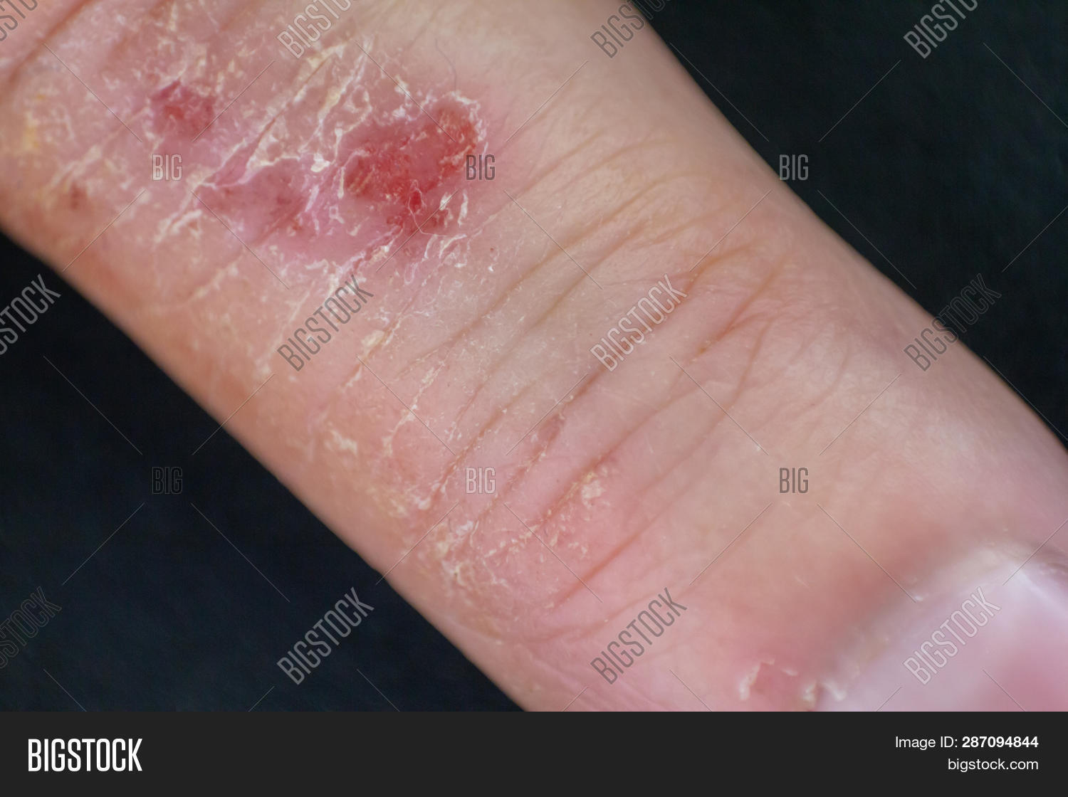 Hand Dermatitis. Hand Image & Photo (Free Trial) | Bigstock