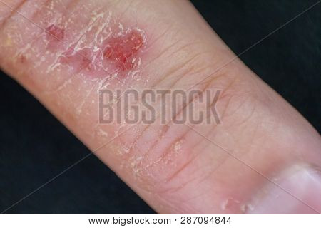 Hand Dermatitis. Hand Image & Photo (Free Trial) | Bigstock