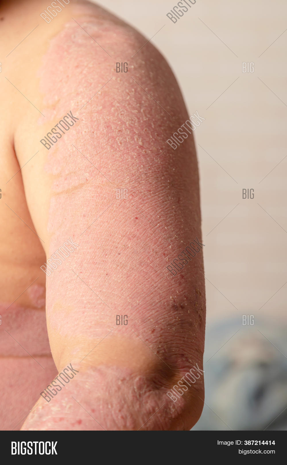Diseases Caused By Image & Photo (Free Trial) | Bigstock