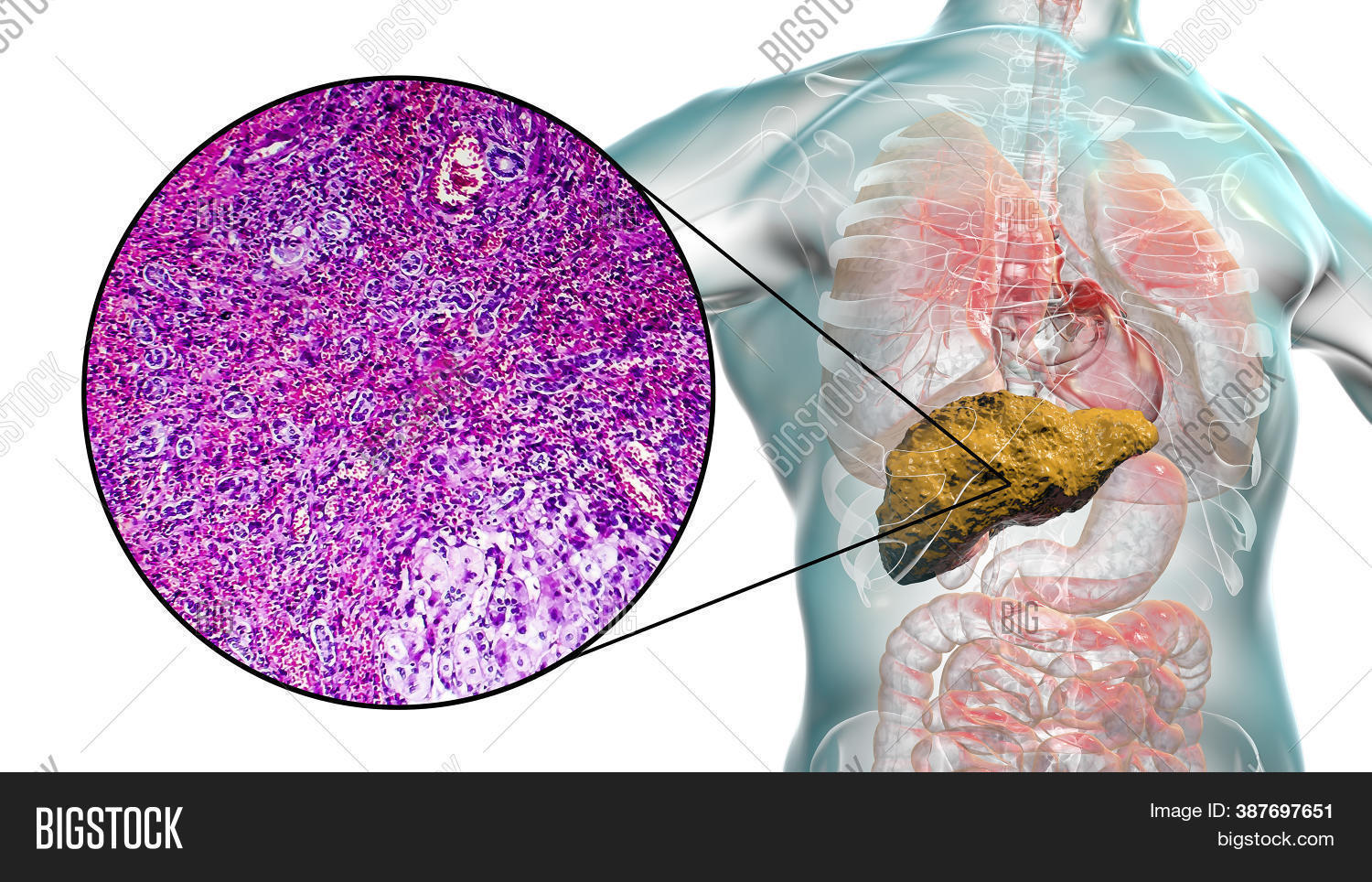Liver Cirrhosis Inside Image & Photo (Free Trial) | Bigstock