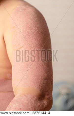 Diseases Caused By Image & Photo (Free Trial) | Bigstock