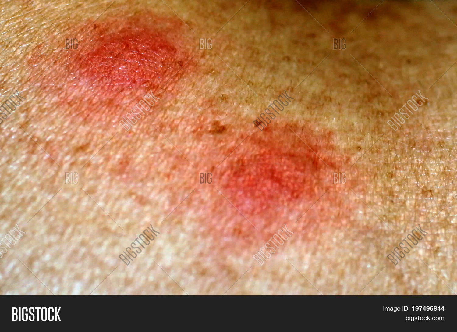 Red Mosquito Bites. Image & Photo (Free Trial) | Bigstock